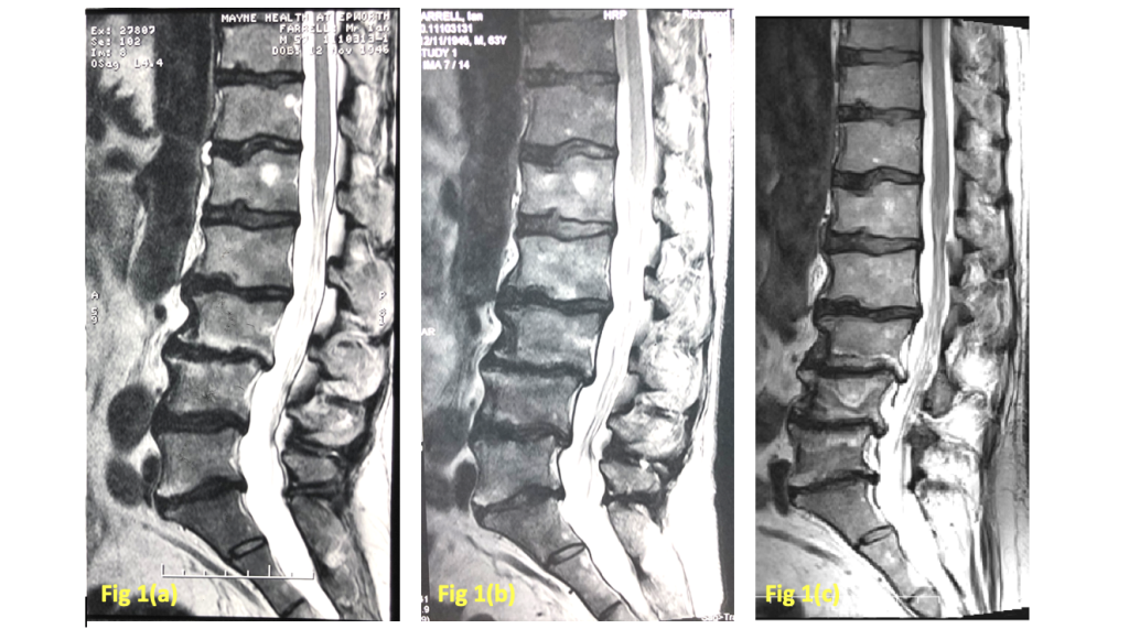 Cox ® Flexion-Distraction Treatment & Management of Post Traumatic