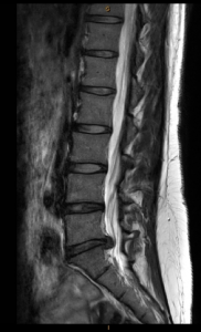 Large L5/ S1 Disc Protrusion Case for Treatment & Management