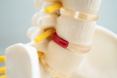 Bulging Disc Non-Surgical Treatment Melbourne | Herniated Disc Specialists